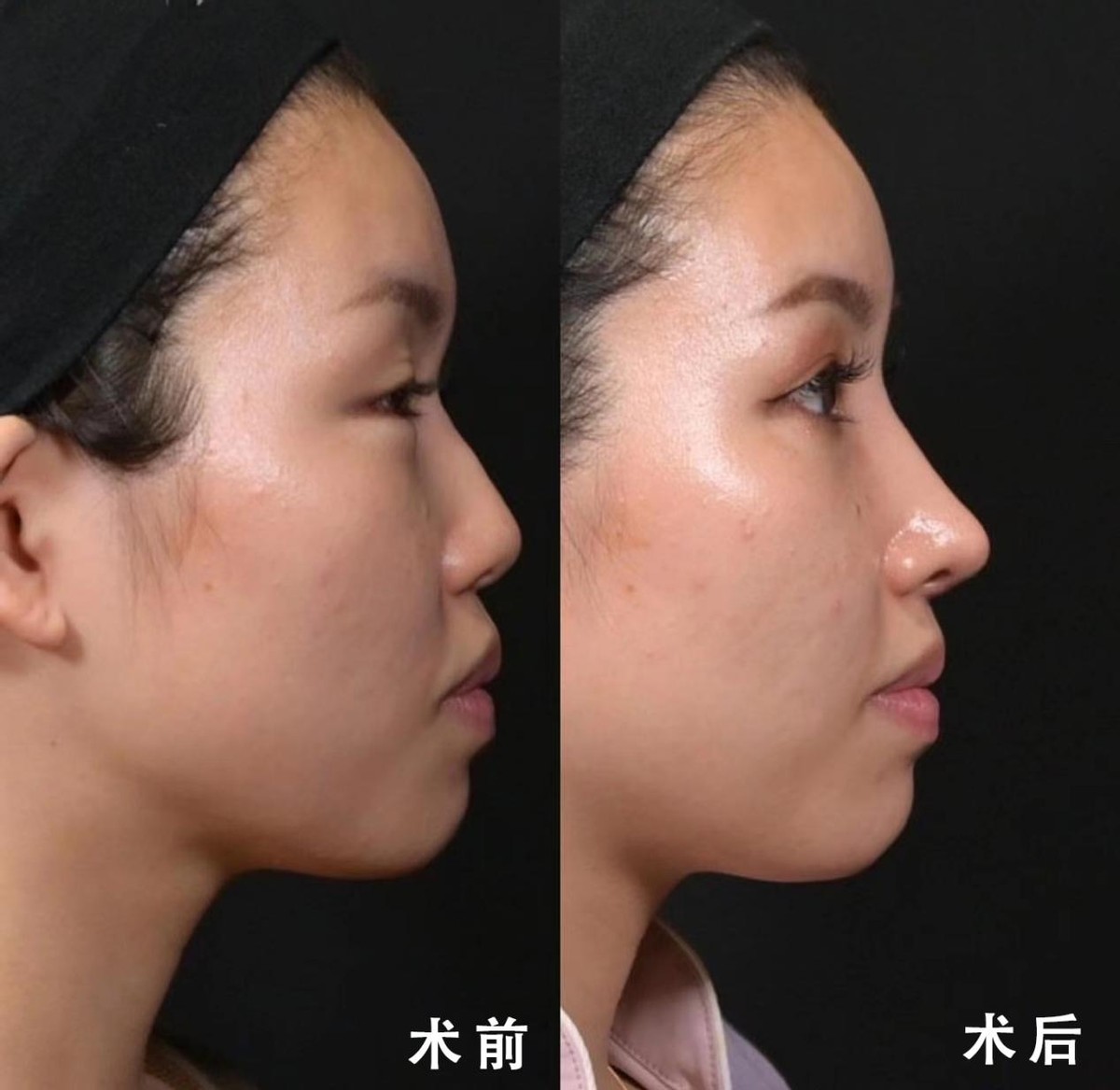 How does a hump nose become a small upturned nose?Do you think this ...