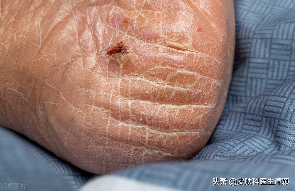 A dermatologist talks to you: several common clinical types of "tinea ...