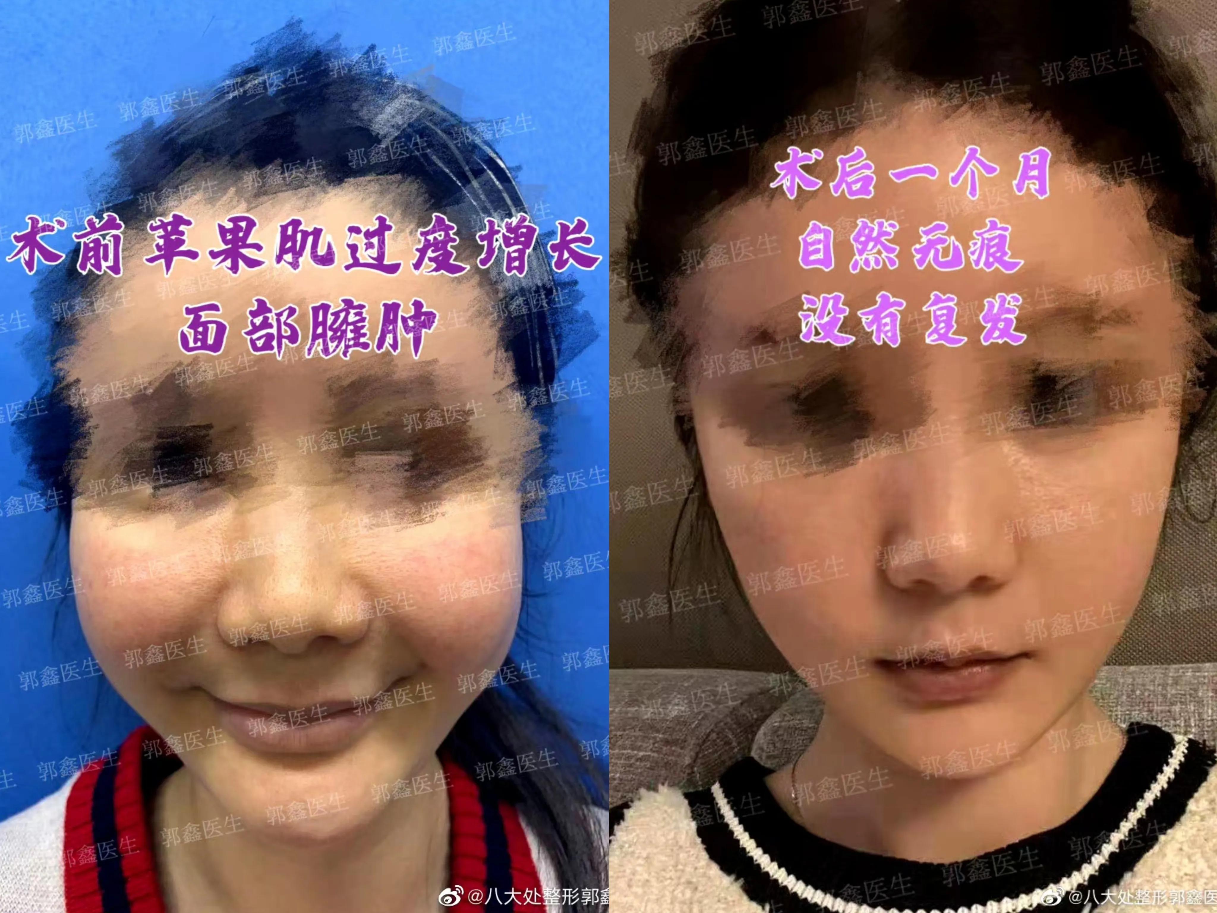34-year-old Lou Yixiao's "plastic surgery" caused controversy, her face was swollen and stiff ...