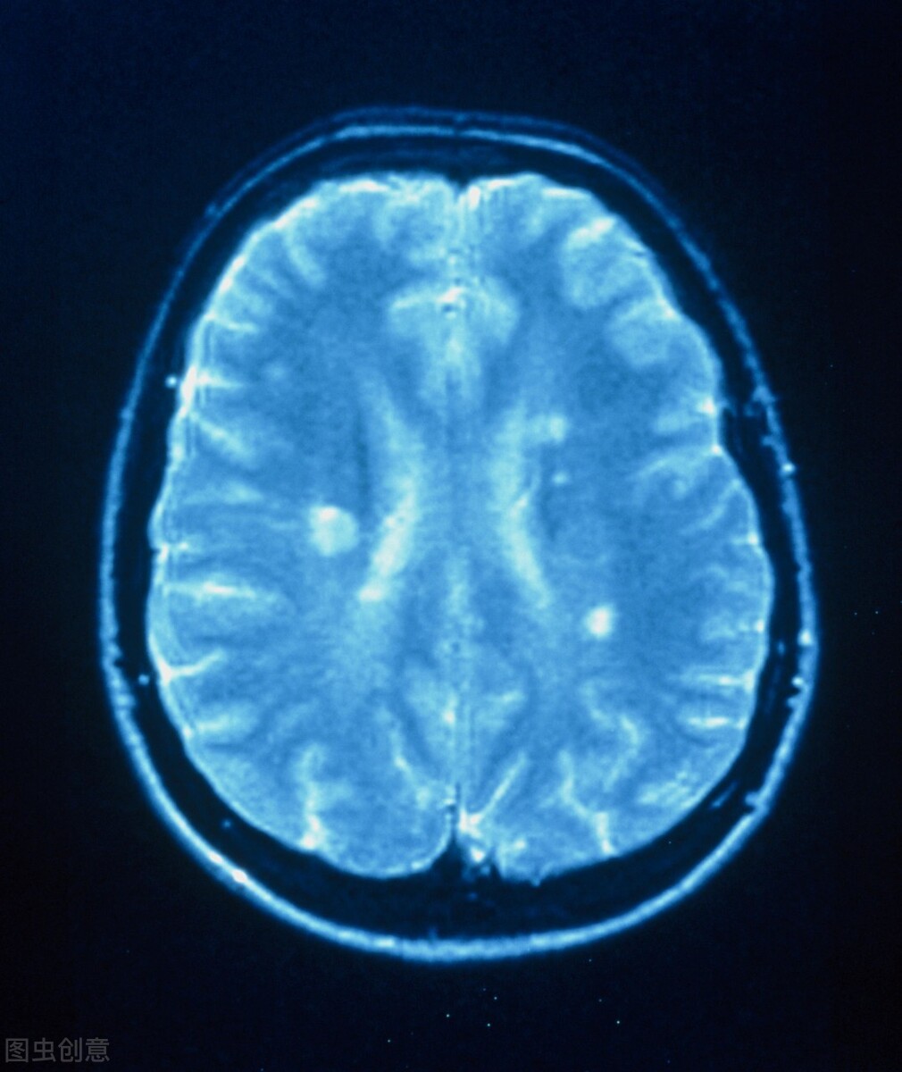 What the hell is multiple sclerosis?Can Chinese medicine be treated ...