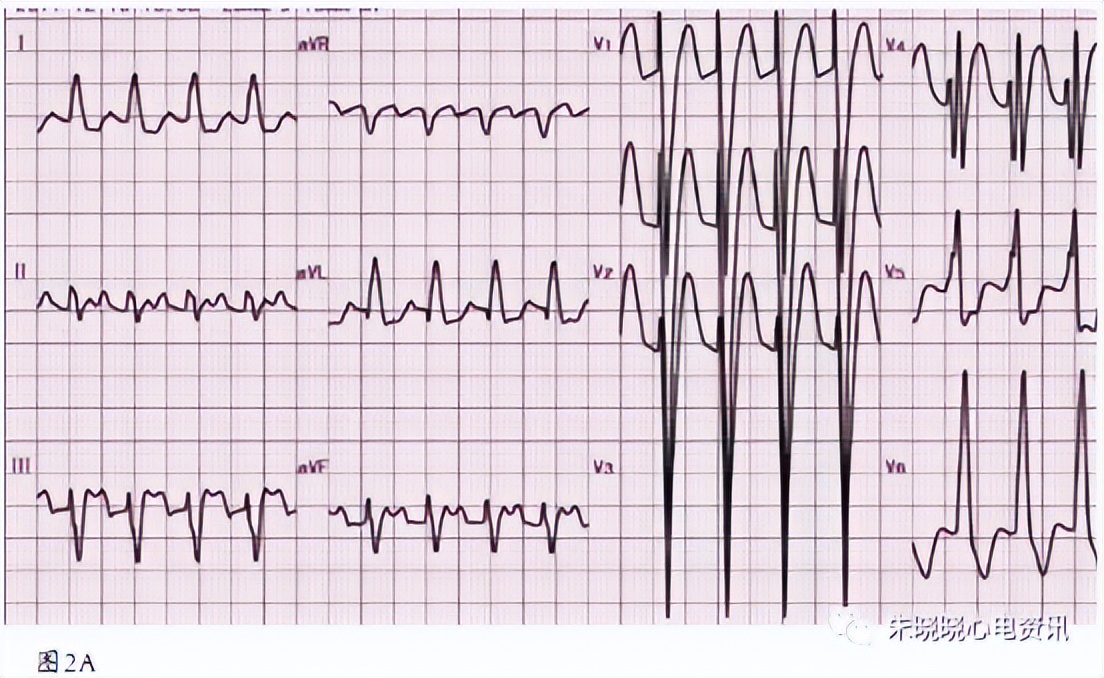 How to identify atrial flutter by electrocardiogram? - iNEWS