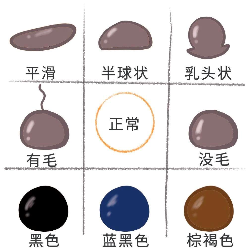 Repeated removal of moles resulted in cancerous changes. The doctor ...