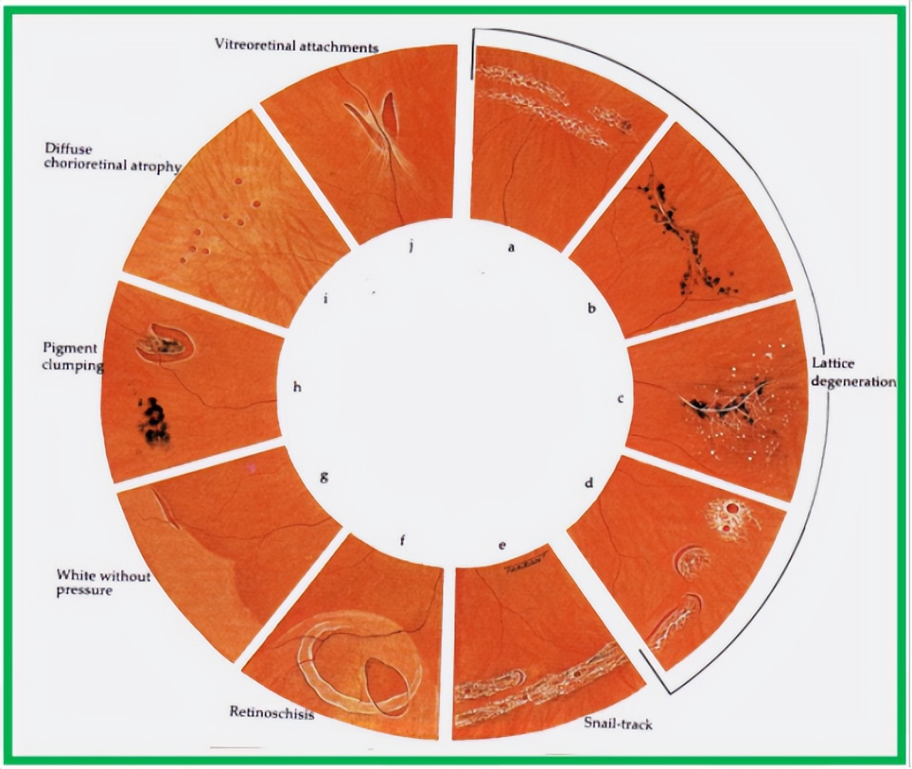 Professor Song Zongming talks about the grading and treatment of myopic ...