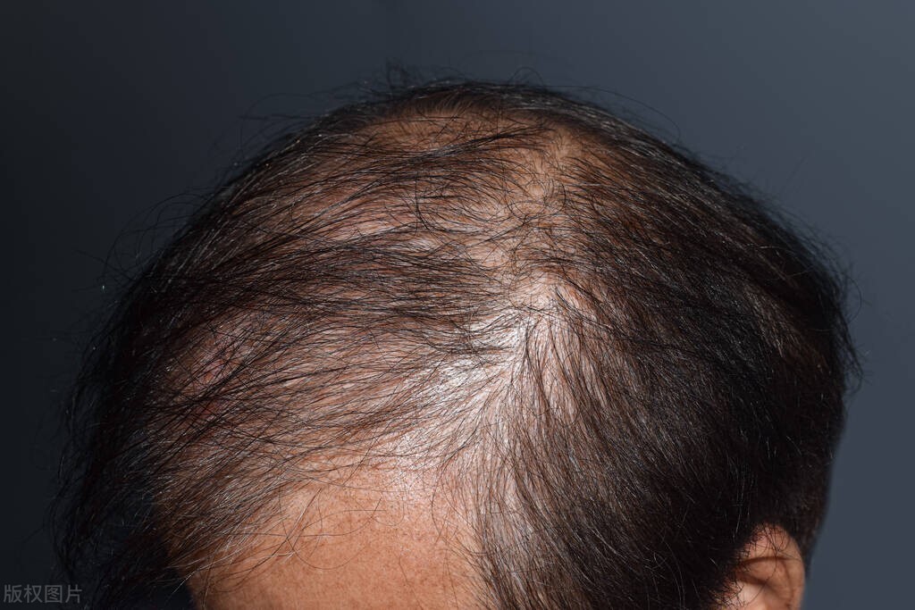 Men with exuberant hair often have strong kidney function! If these 3 ...