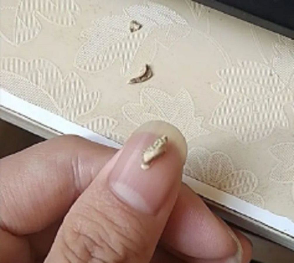 How easy is it to remove dental calculus? You can do it in three steps ...