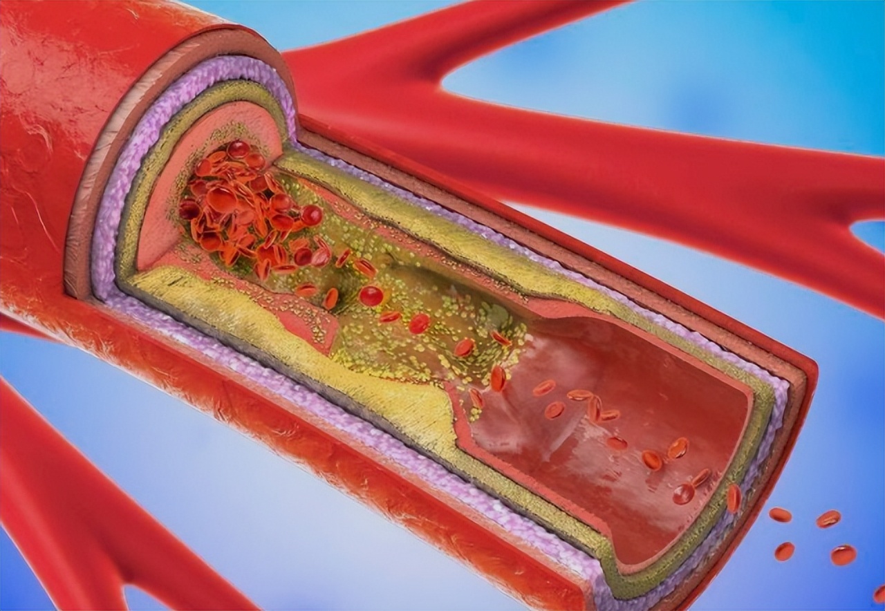 Keeping blood vessels open is the key to longevity? Do 6 things well ...