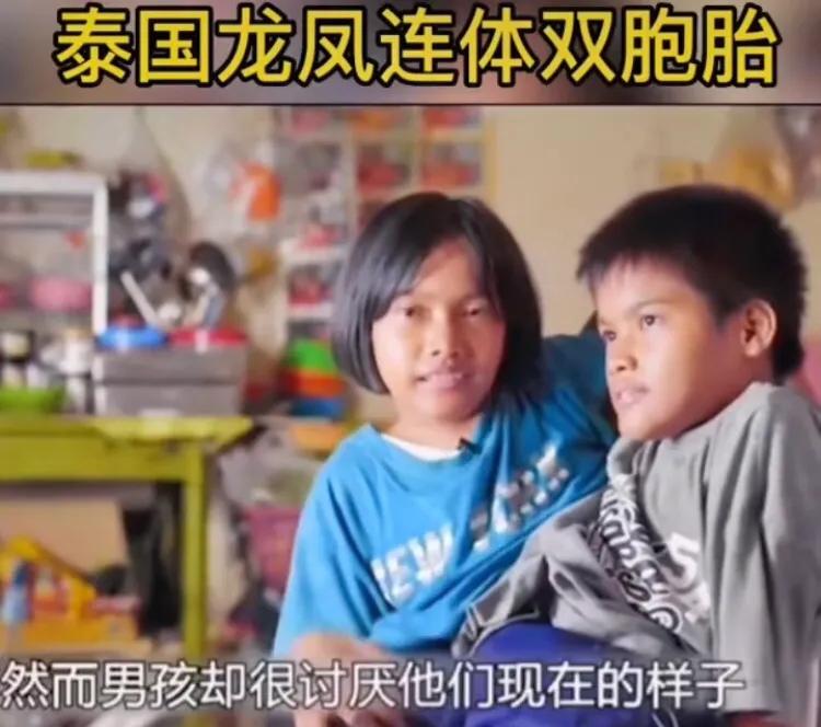 Rare conjoined twins in good condition - iNEWS