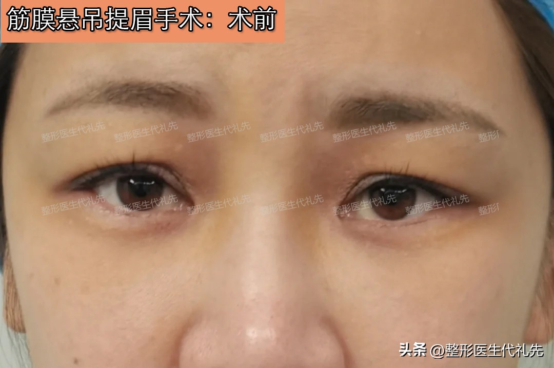 The skin of the triangular eye is sagging and looks sad. After eyebrow ...