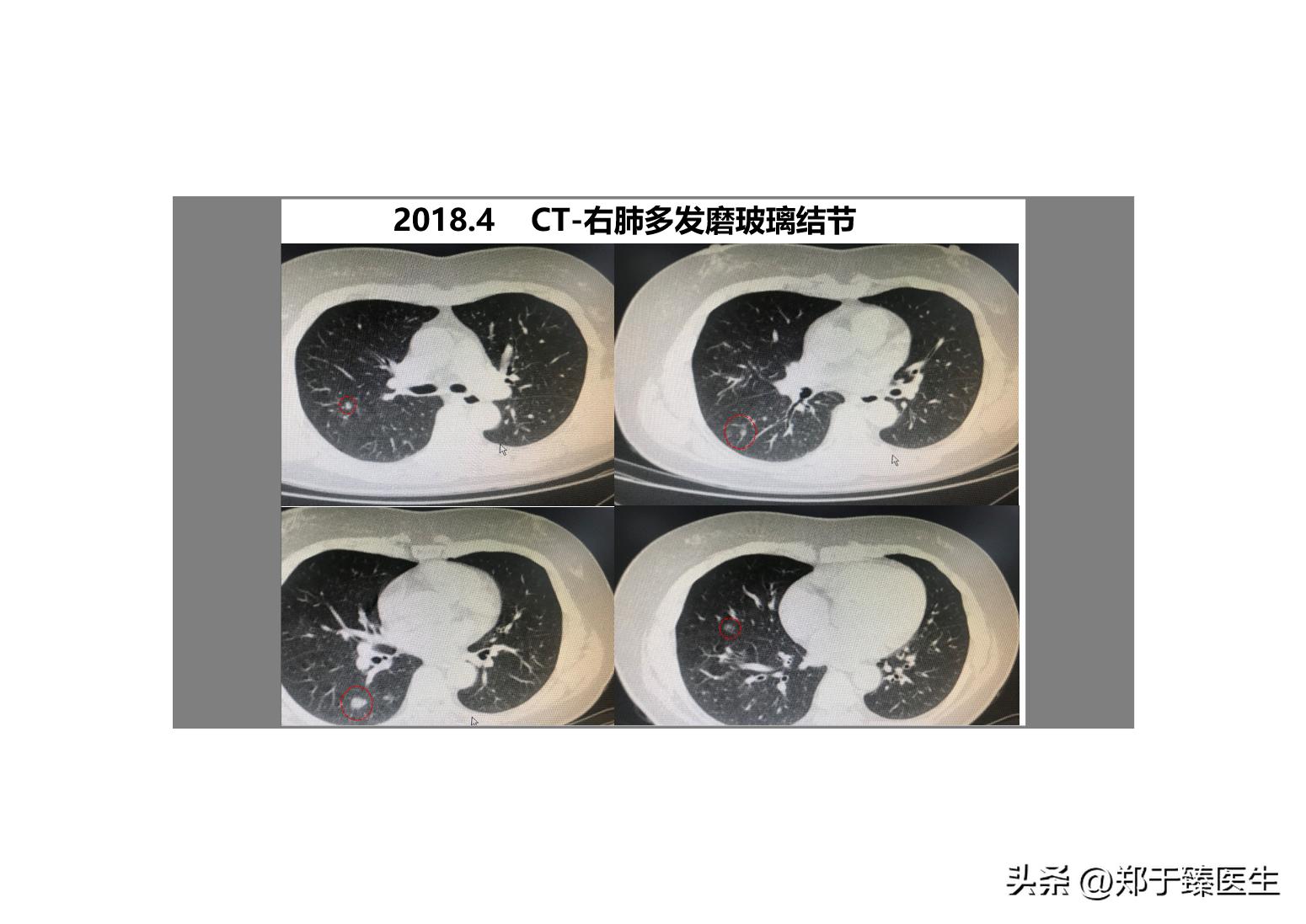[Ground glass nodules] follow-up points and common treatment methods ...