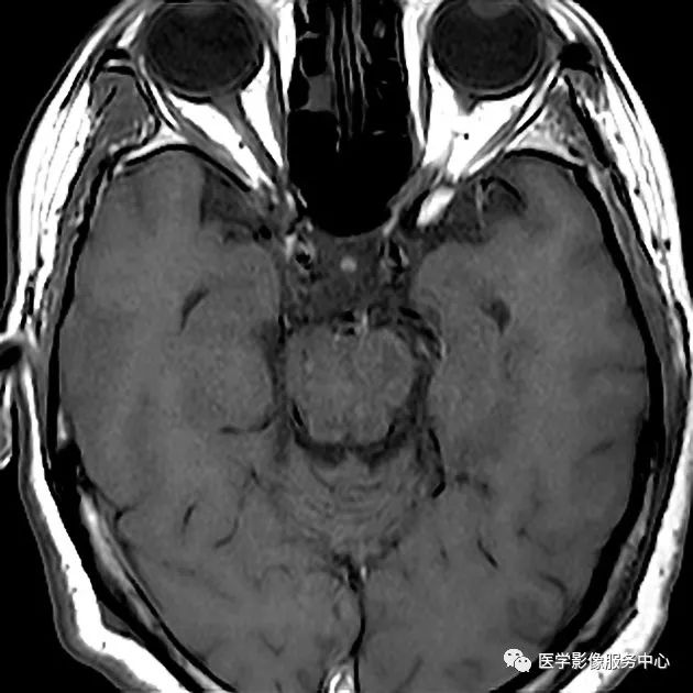 The imaging features of vacuolar sella, these three signs should be ...