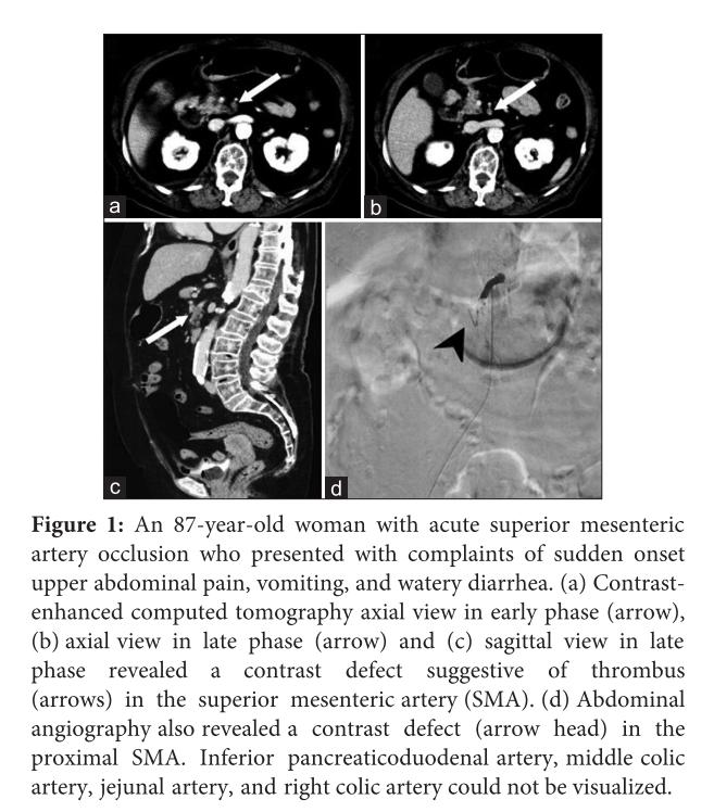 Interventional Literature No. 5 - Solitaire Thrombotic Stent for Acute ...