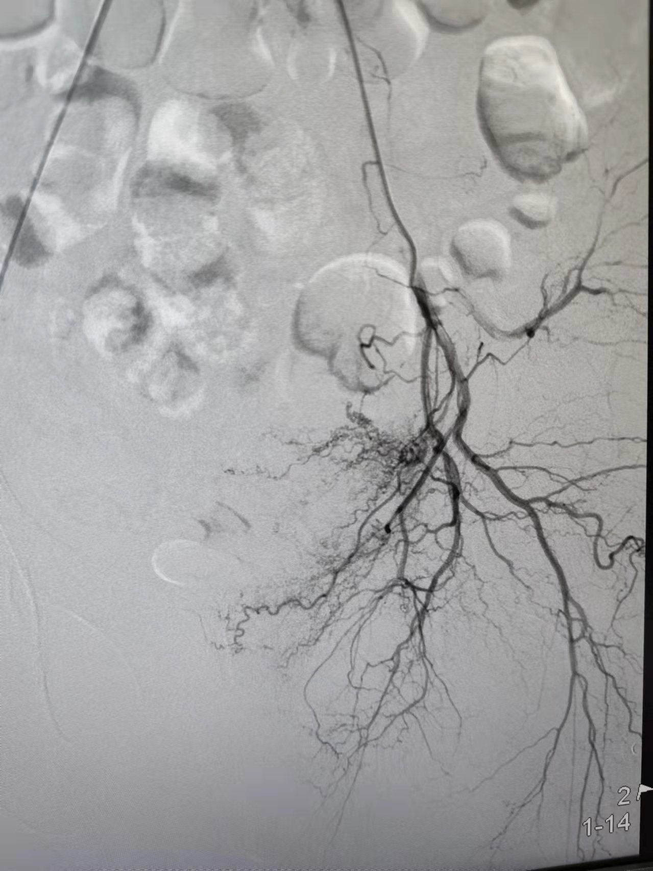 Repeated bleeding after radiotherapy and chemotherapy for cervical ...