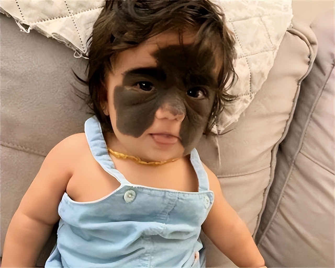 The baby girl became popular because of the birthmark on her face. How ...