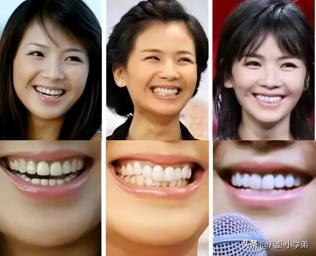 How terrible is the star "porcelain tooth"?The mouth is very old, the ...