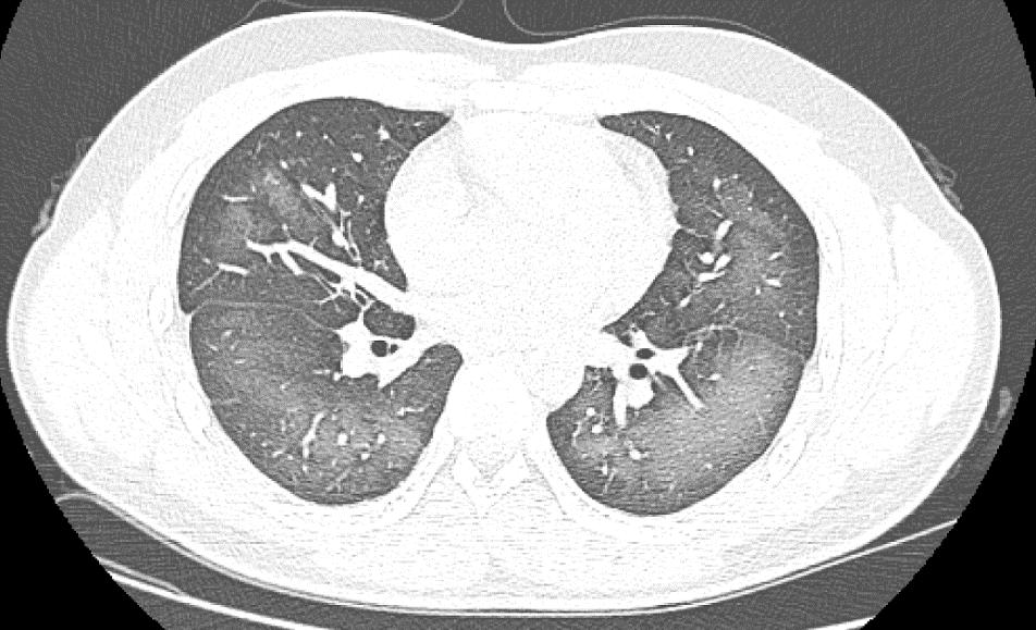 See also "white lung"! People who often use this spray should be ...