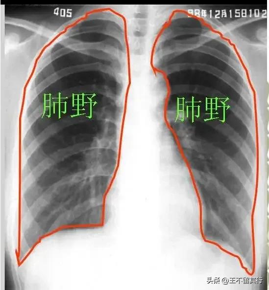 How to understand "increased lung markings" in imaging diagnosis? - iNEWS