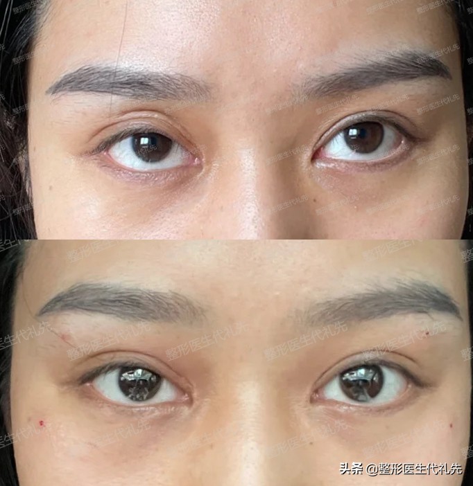 What kind of filling materials are needed to fill the sunken eye ...