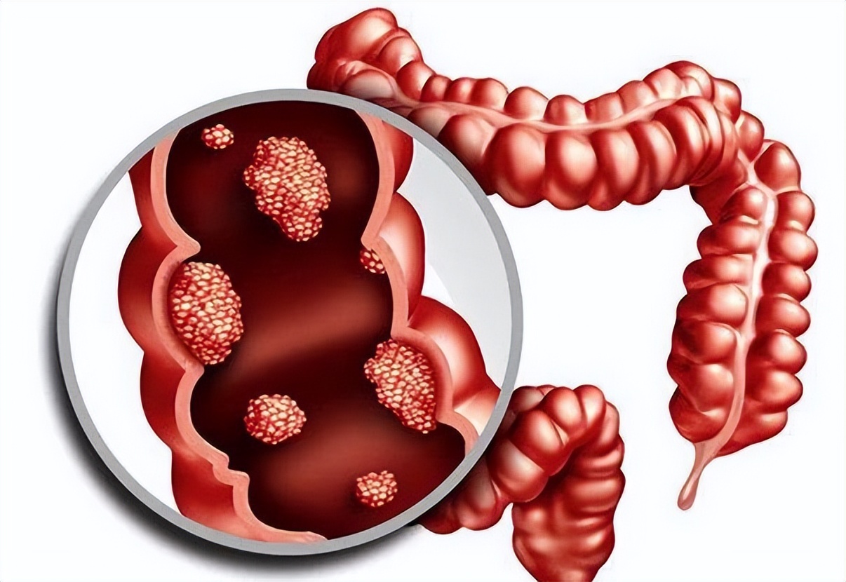 Don't drag intestinal polyps into bowel cancer, doctor's advice: If ...