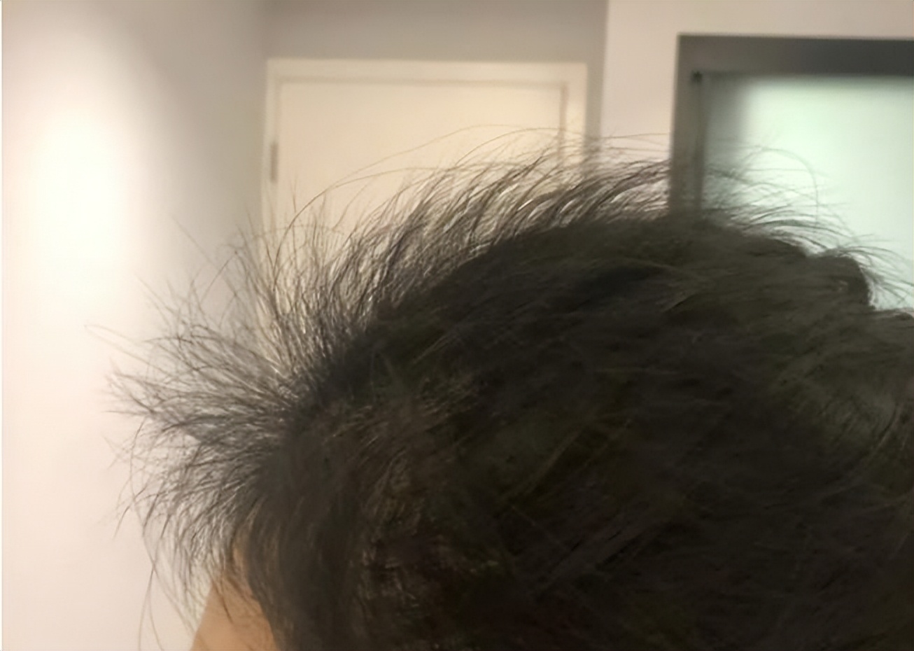 Sparse on the top of your head and still love hair loss?Teach you how ...