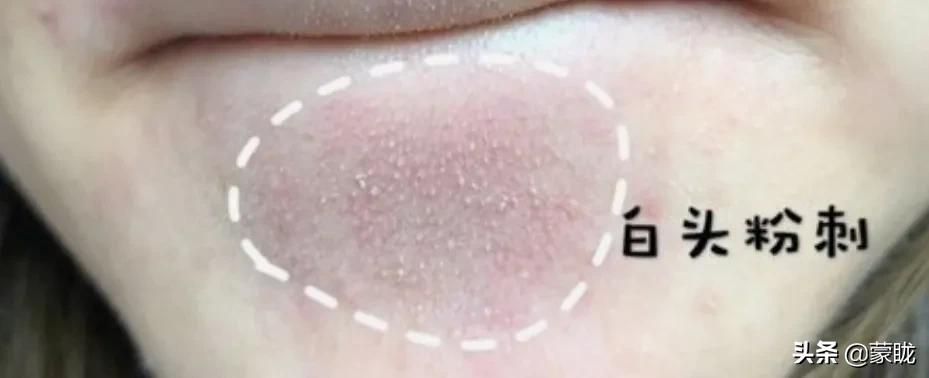 Do you know what the little white dot on the chin is?But don't ignore ...