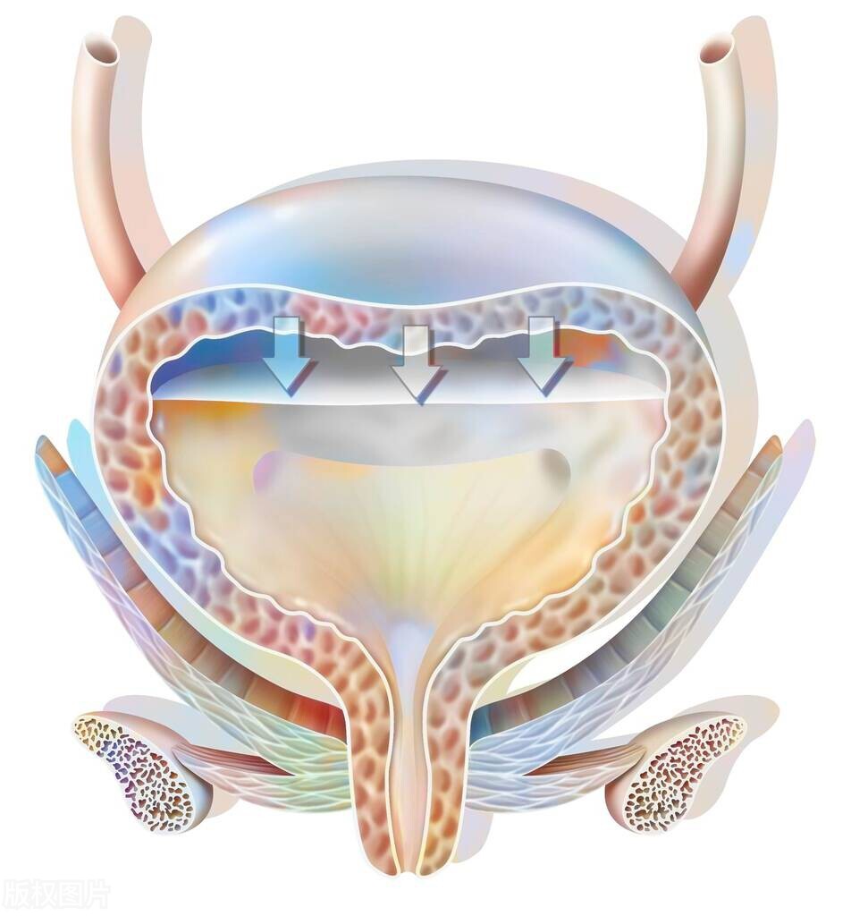 How does prostatic hyperplasia cause trabecular bladder? - iMedia