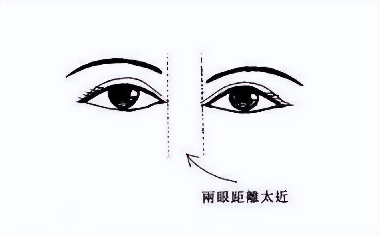 The distance between the eyes is close, can the inner corner of the eye ...