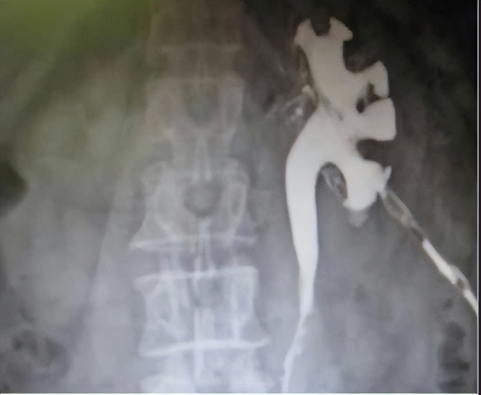 Etiology, diagnosis and treatment of chyluria - iNEWS