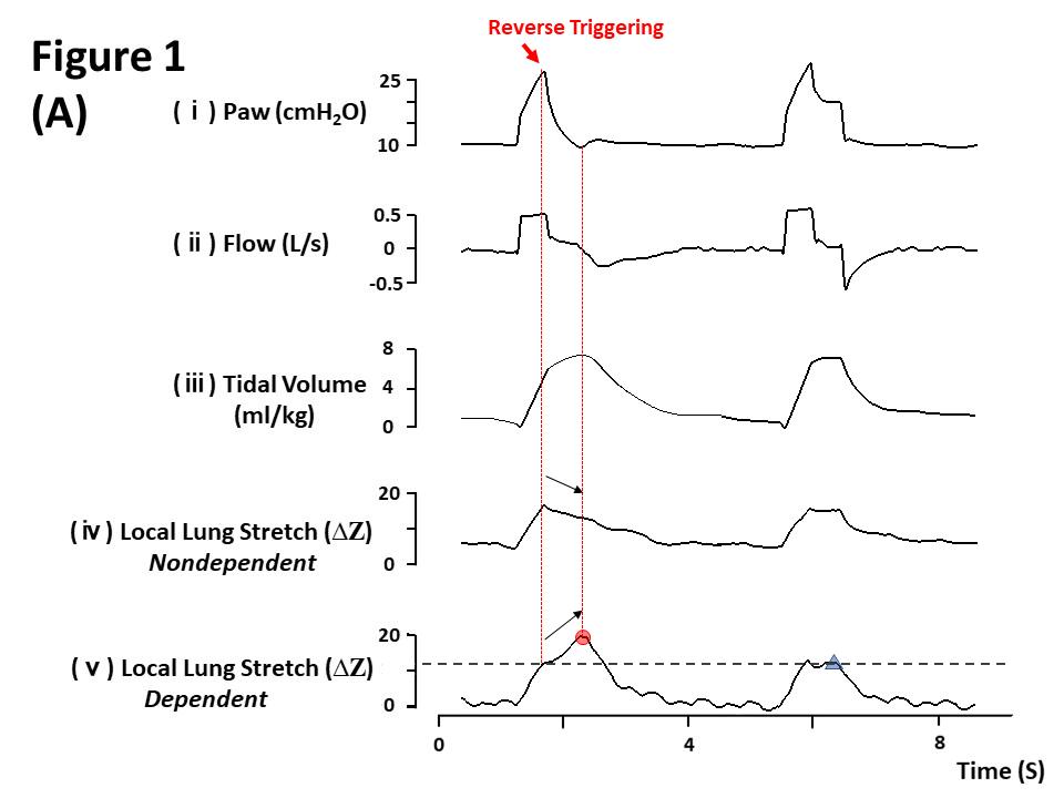 Professor Luo Hong: How to identify "reverse trigger" during mechanical ventilation and view its ...