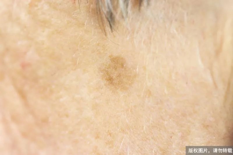 A 25-year-old girl develops age spots! Many people have these habits of ...