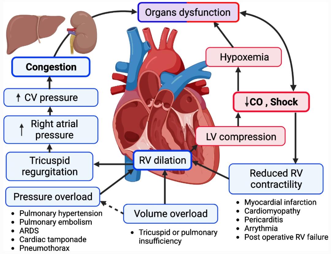 Recognition and management of acute right ventricular failure - iNEWS