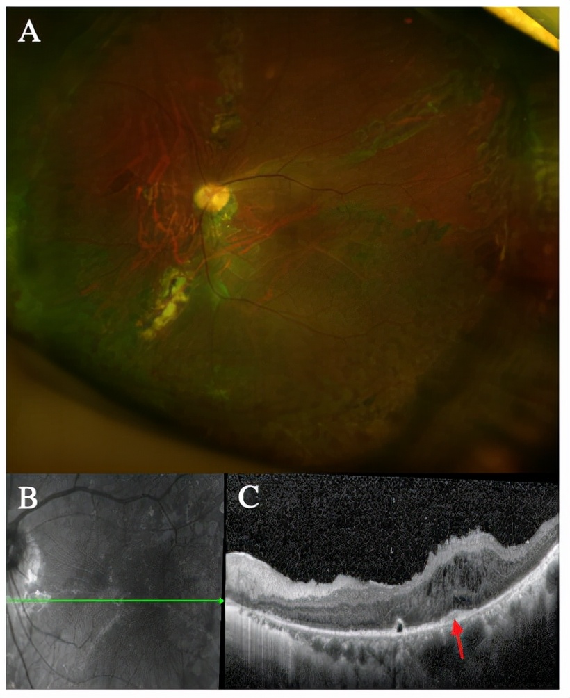 Reattached and detached retina-the basis for prevention and treatment ...