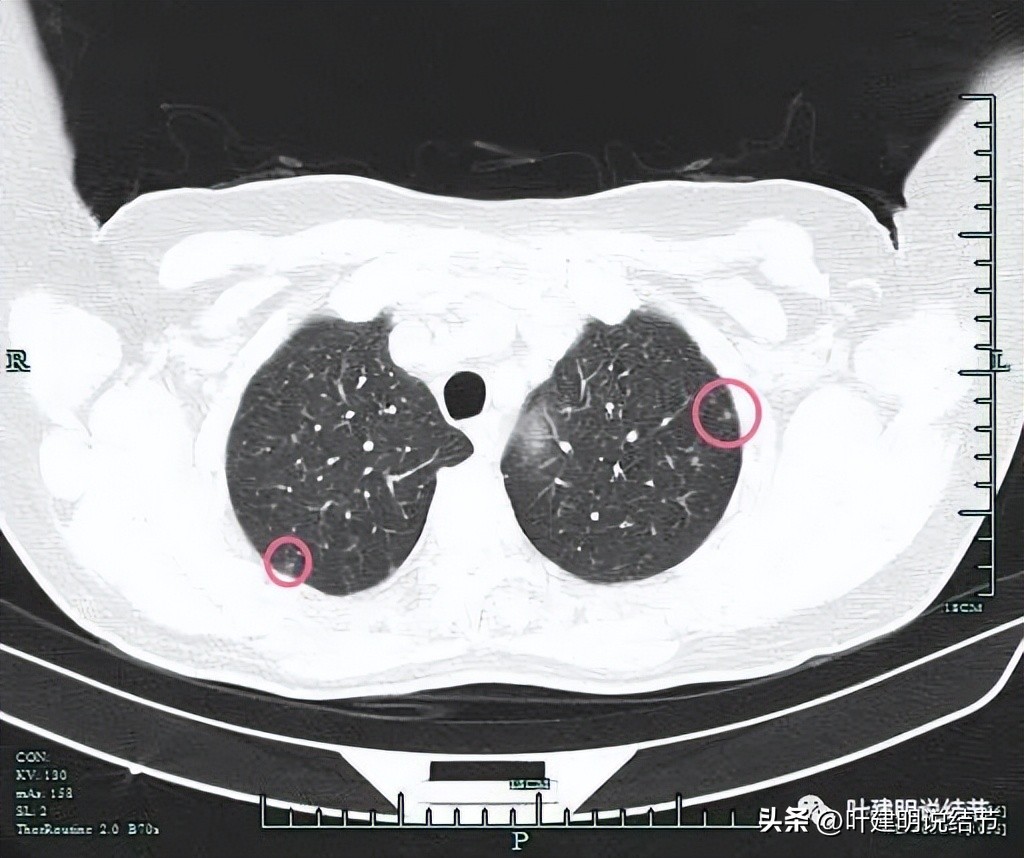 Why is such a solid nodule with vascular signs, burrs and pleural ...