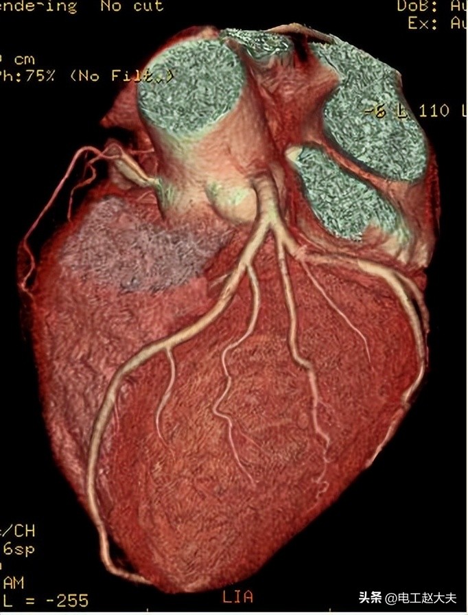 What is coronary myocardial bridge?is it serious? - iNEWS
