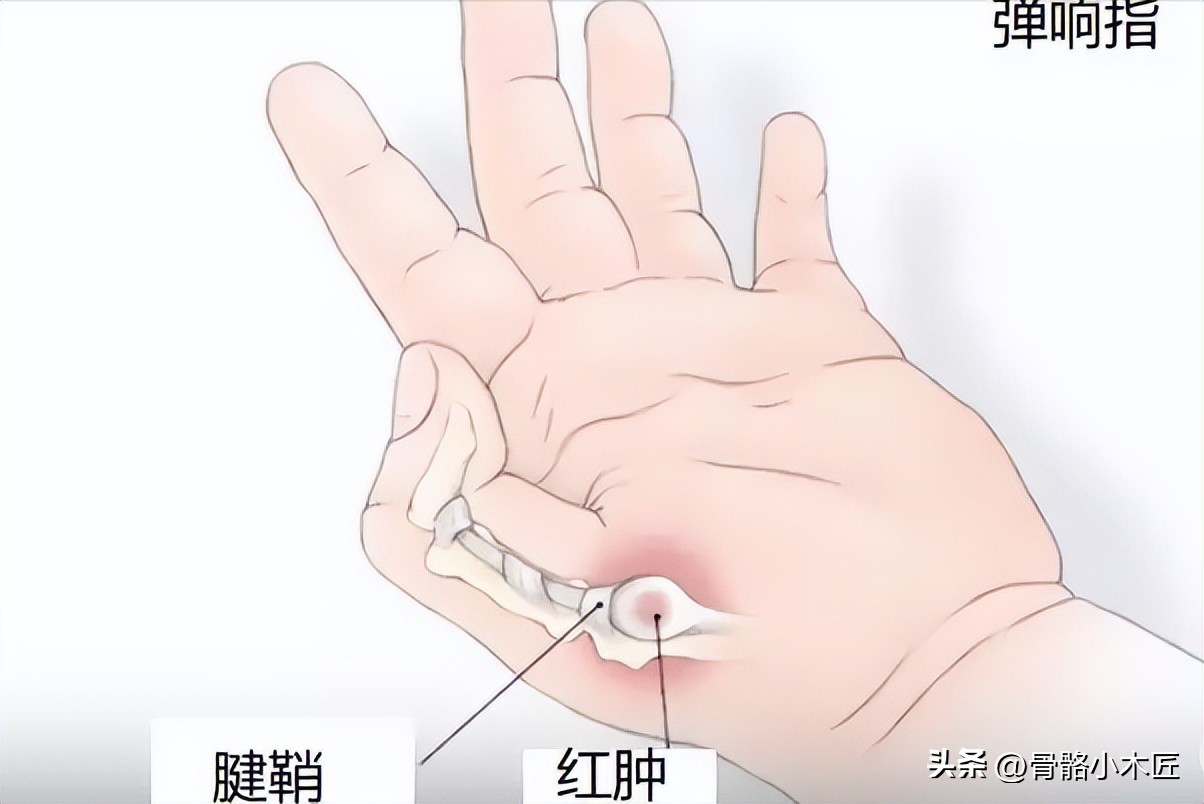 Stenosing tenosynovitis of chronic injury of motor system - iMedia