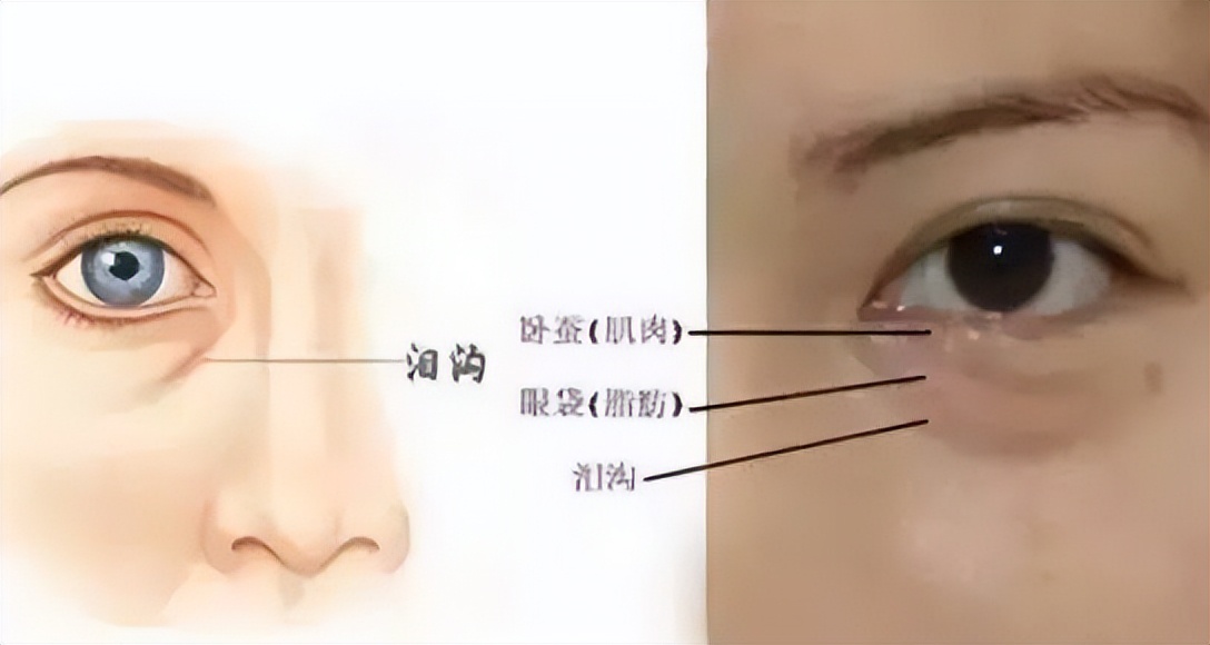 How to remove the most reliable tear trough - iMedia