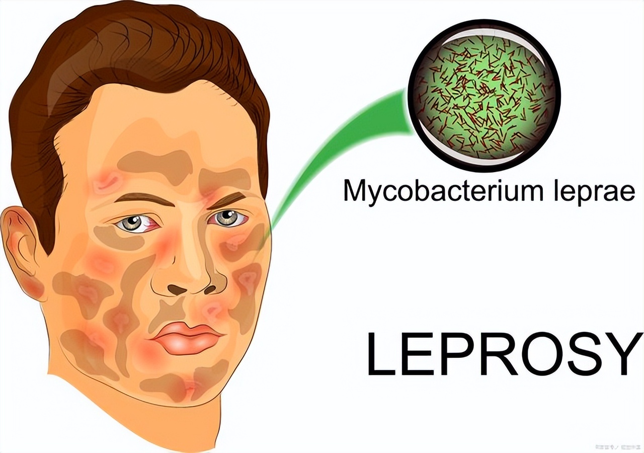 How much do you know about leprosy - iNEWS