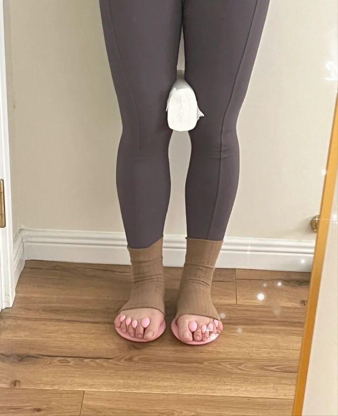 O-shaped leg correction straight leg plastic surgery done in Shanghai ...