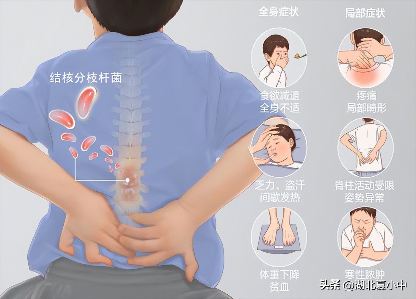 Bone tuberculosis is mostly secondary to pulmonary tuberculosis, which ...