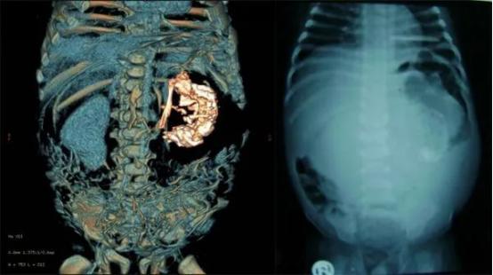 Foreign media: 8 parasitic fetuses removed from 3-year-old girl's ...