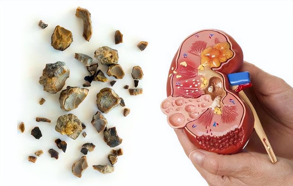 What you need to know about kidney stones - iNEWS
