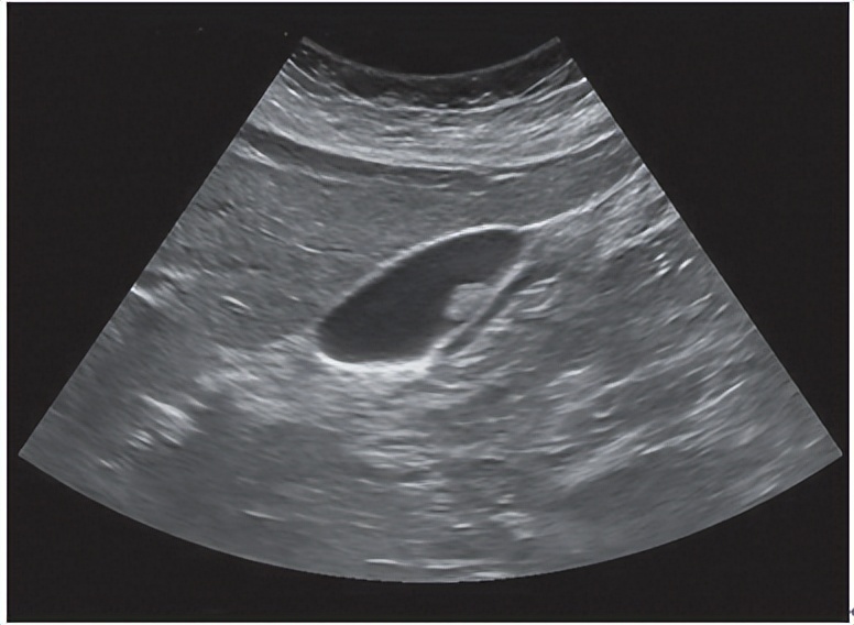How are gallbladder polyps treated? Find out first, then determine the ...