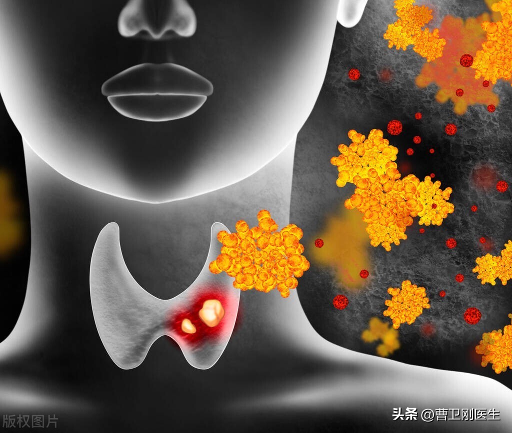 Standardized treatment: whether 131 iodine therapy can benefit after ...