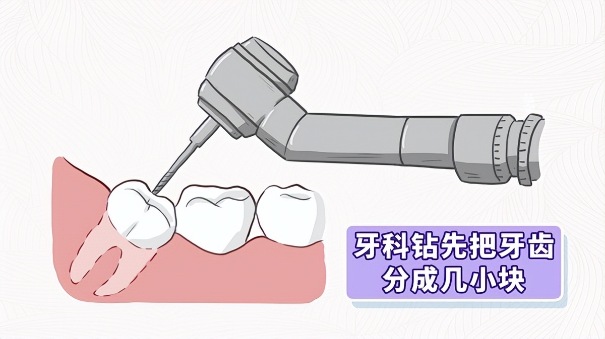 Tooth extraction is no longer a nightmare, it can be minimally invasive ...