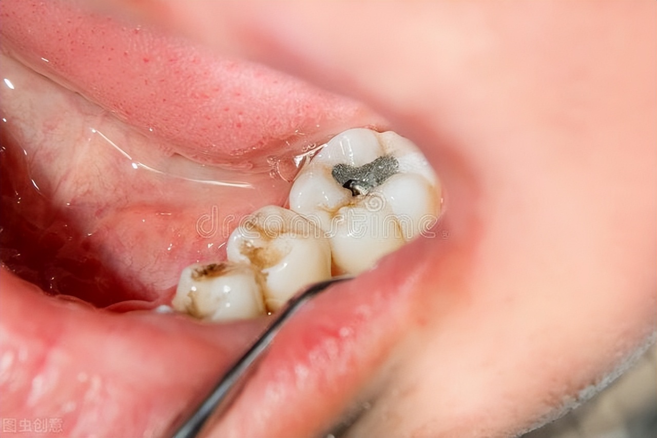 Why do you need to drill holes in your teeth after rotten teeth?Dental ...