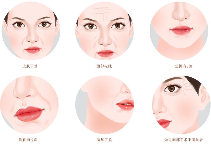 Thread Sculpture for Facial Rejuvenation - iNEWS