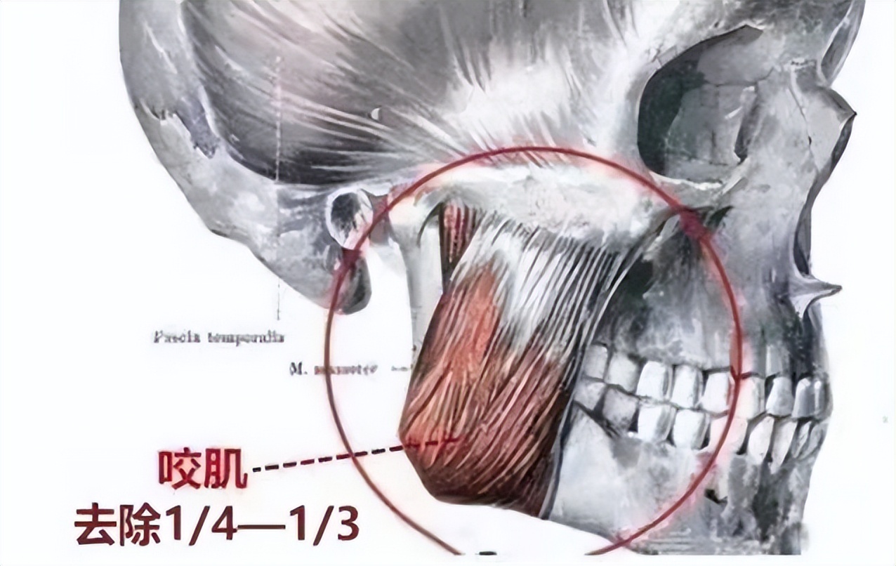 Will the masseter muscle grow back after it is removed? - iNEWS