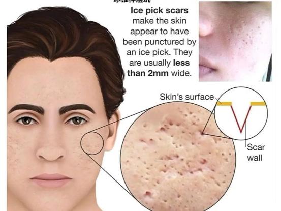 The face is full of pimples and pimples, which are all eliminated in ...