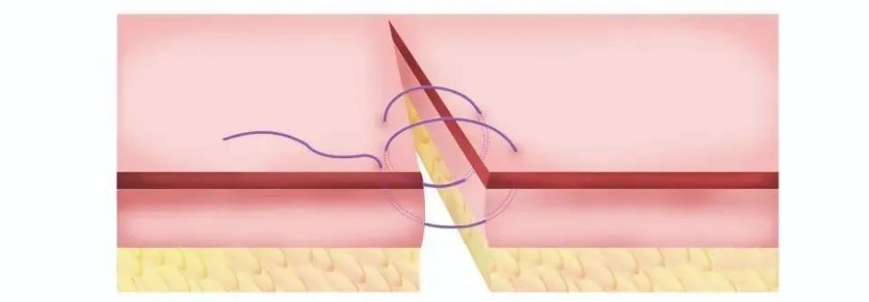 How to suture the cesarean section wound to look good? - iMedia