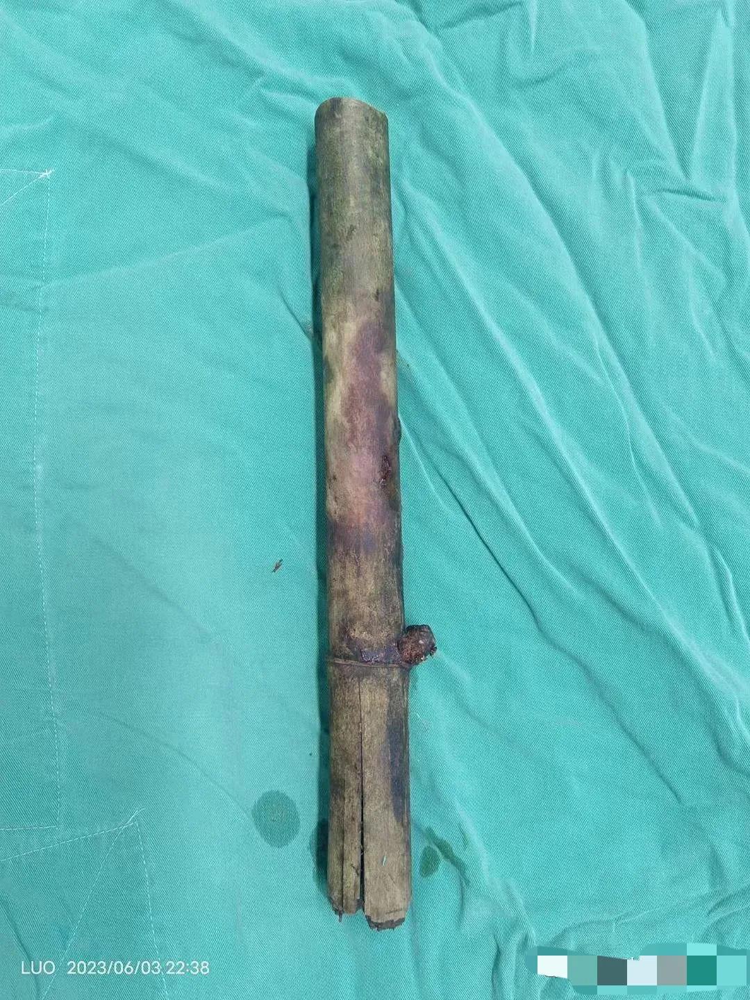 A man's outdoor diving accident happened, and his body was pierced by a ...