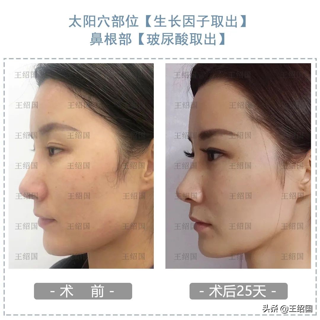 236-day recovery situation and process after temple growth factor ...